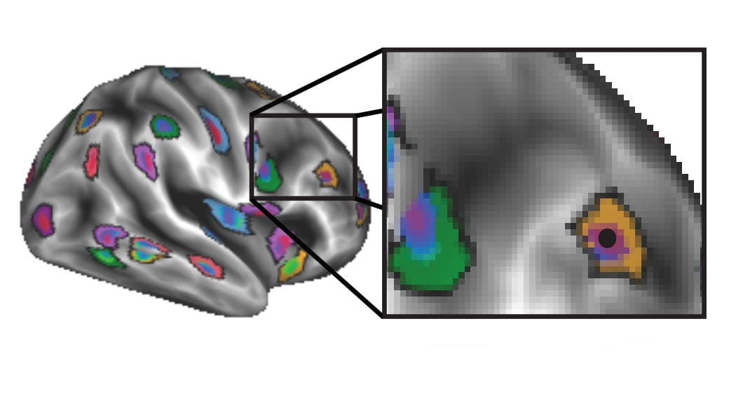CAMH study shows details of brain networks in autism | CAMH